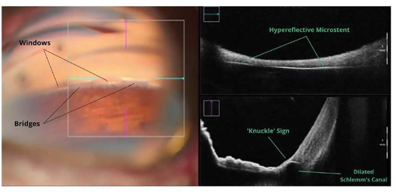Intraoperative OCT in Glaucoma Surgery | Glaucoma Physician