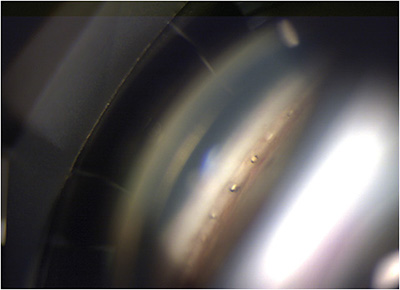 Current Status of Excimer Laser Trabeculostomy | Glaucoma Physician