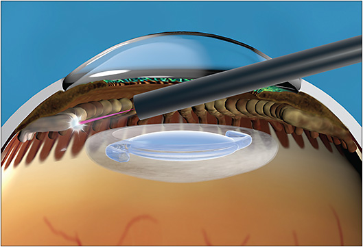 Combining Endoscopic Cyclophotocoagulation With Microinvasive Glaucoma ...