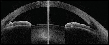 Lens Extraction With Endocycloplasty to Treat Plateau Iris | Glaucoma ...